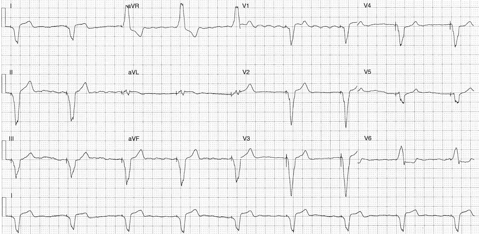 ECG of the Week: ECG of the Week - 27th August 2018