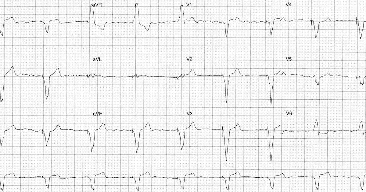 ECG of the Week: ECG of the Week - 27th August 2018 - Interpretation