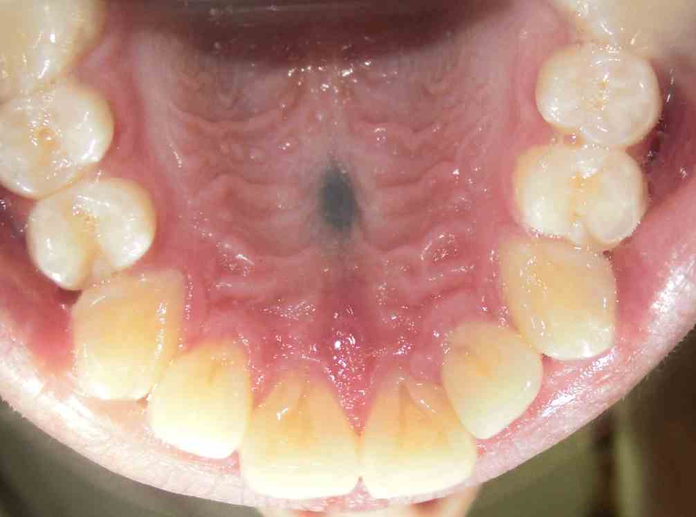 Lesiones orales pigmentadas
