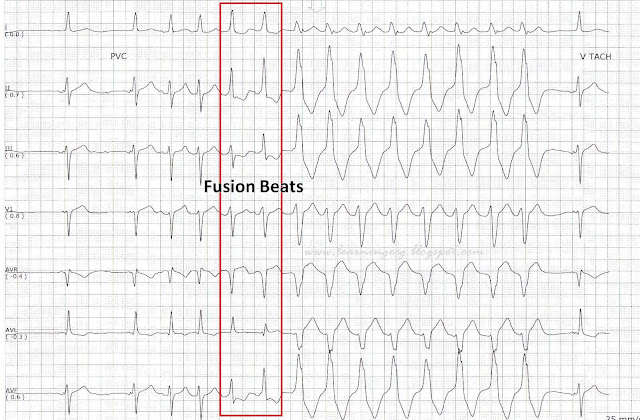 ECG Rhythms: Fusion Beats