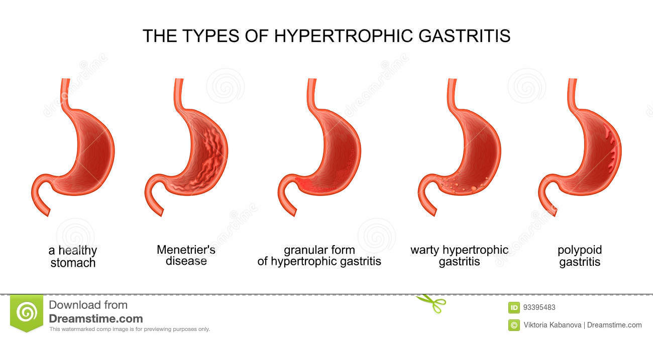 Você Tem Gastrite? Aprenda 4 Formas Para Lidar Com Ela - Saúde ...