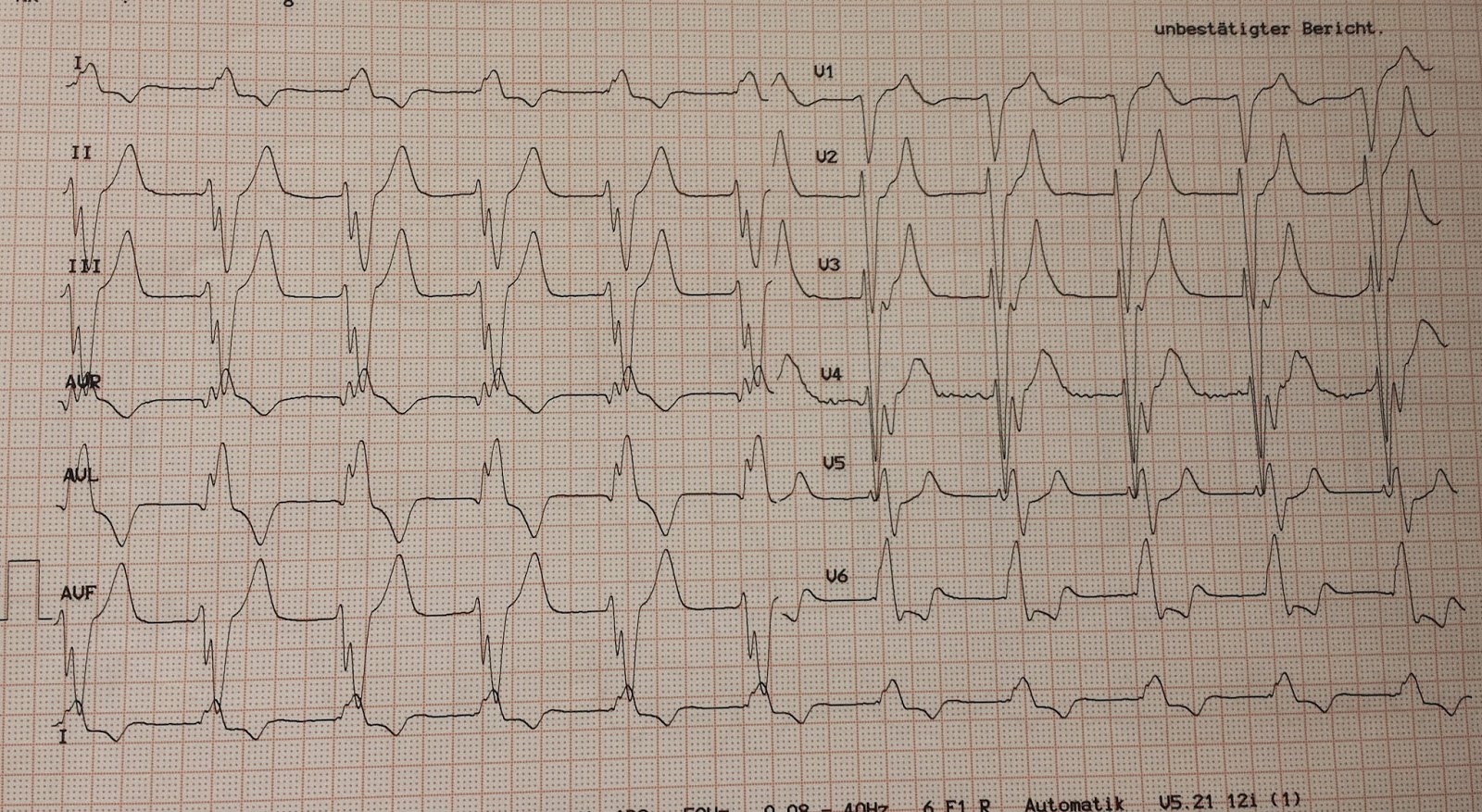 Dr. Smith's ECG Blog: A Very Wide Complex Tachycardia. What is the ...