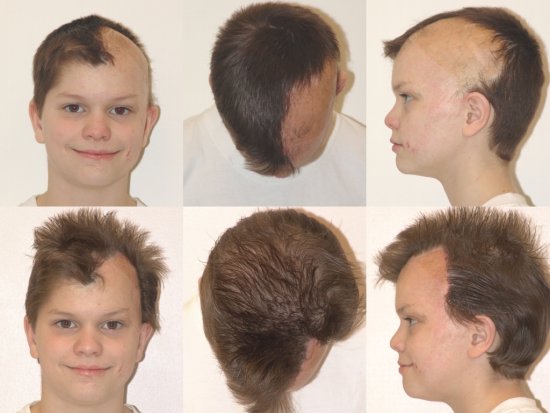 Hair Transplant Surgery : In auto cloning hair can be treated either ...