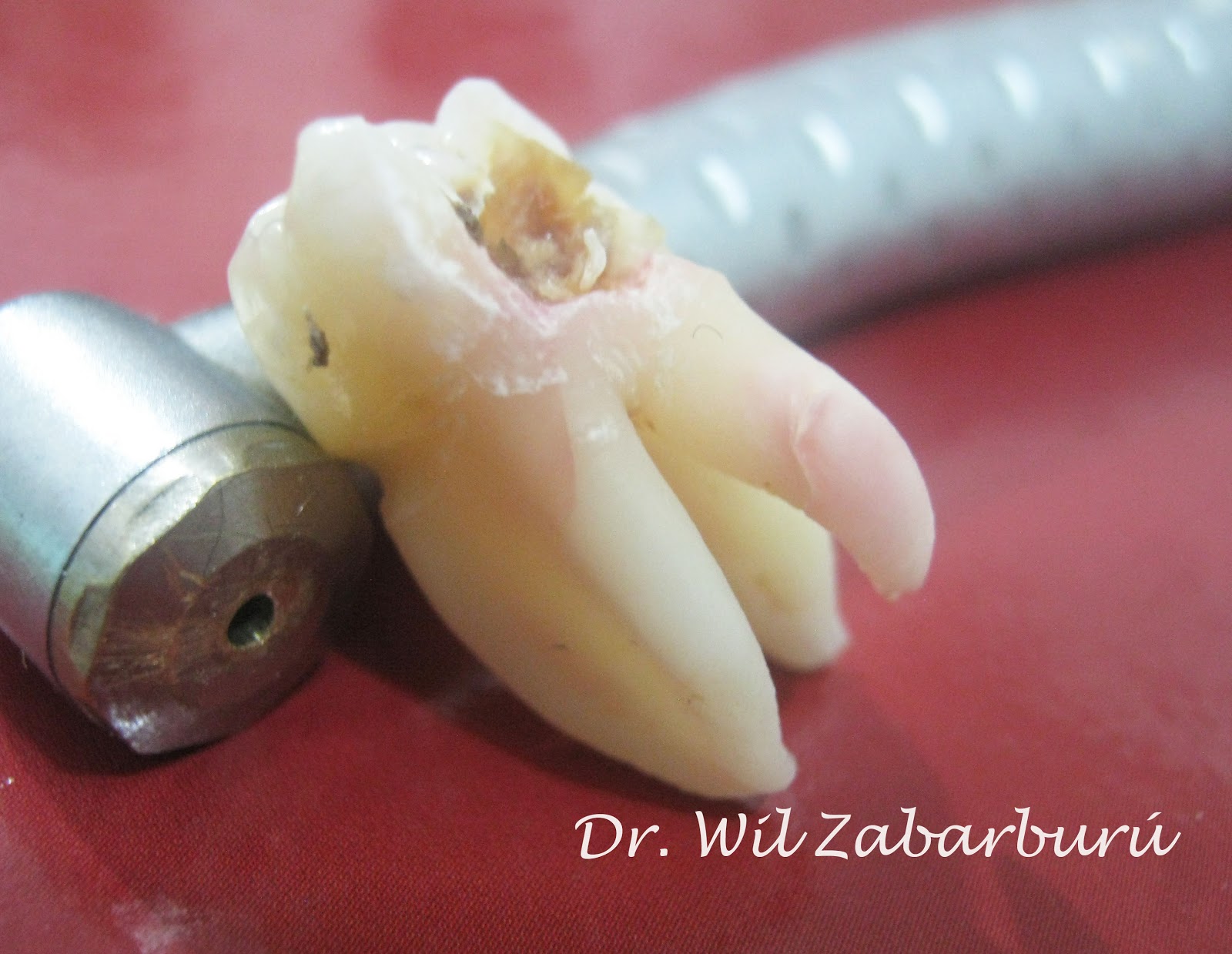 CLINICA DENTAL ASISTENCIAL: RADIX ENTOMOLARIS