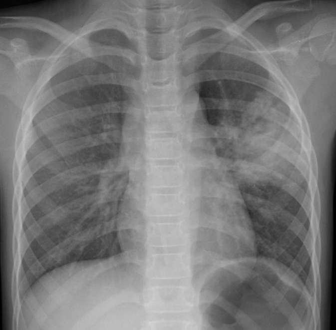 소청과 전공의 및 일반인을 위한 교육자료: 괴사성 폐렴 (necrotizing pneumonia)
