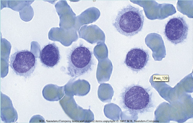 Células sanguíneas: Leucemia Linfoide y Mieloide Crónica