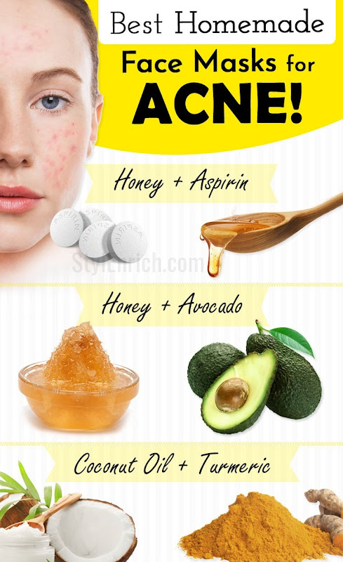 Best Homemade Face Mask for Acne