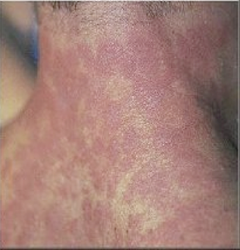 Vlogging: The regulation of laser hair removal from a doctors perspective