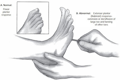 The plantar reflex - Babinski's sign