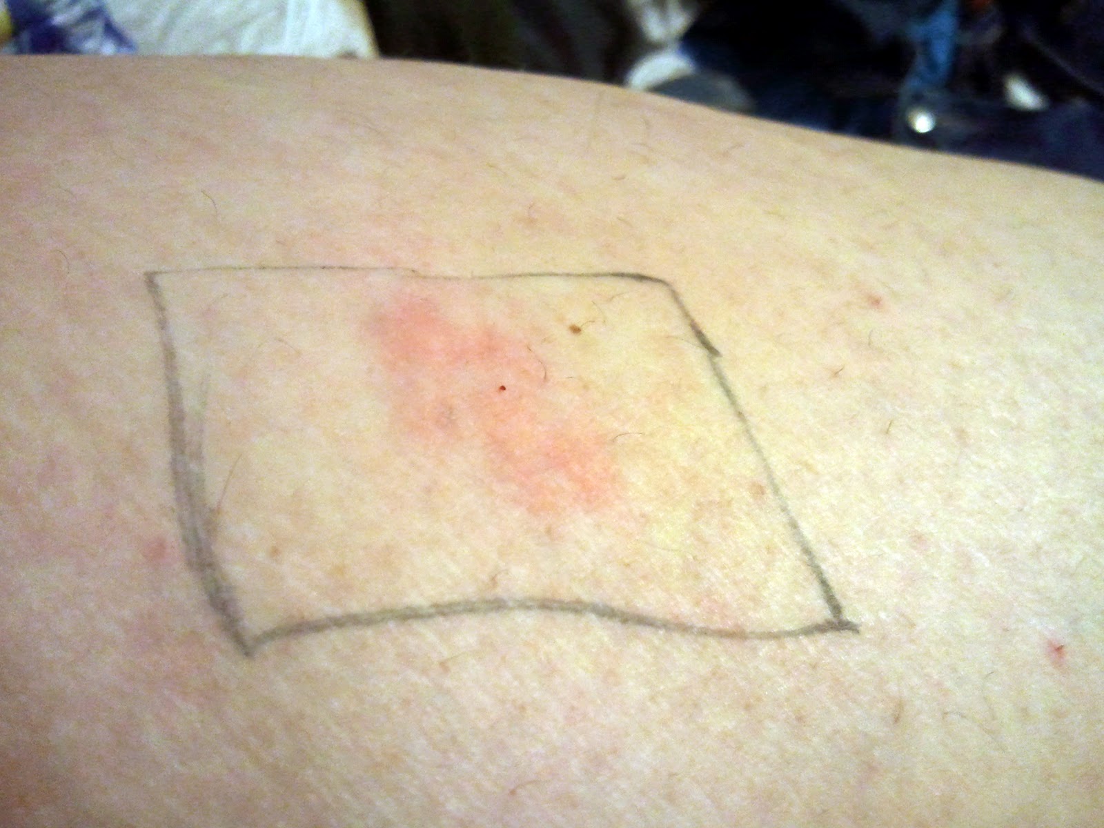 Copaxone Reactions: The Good, The Bad and the Ugly: How I do it