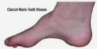 Medical Treatment Pictures-for Better Understanding: Charcot-Marie ...