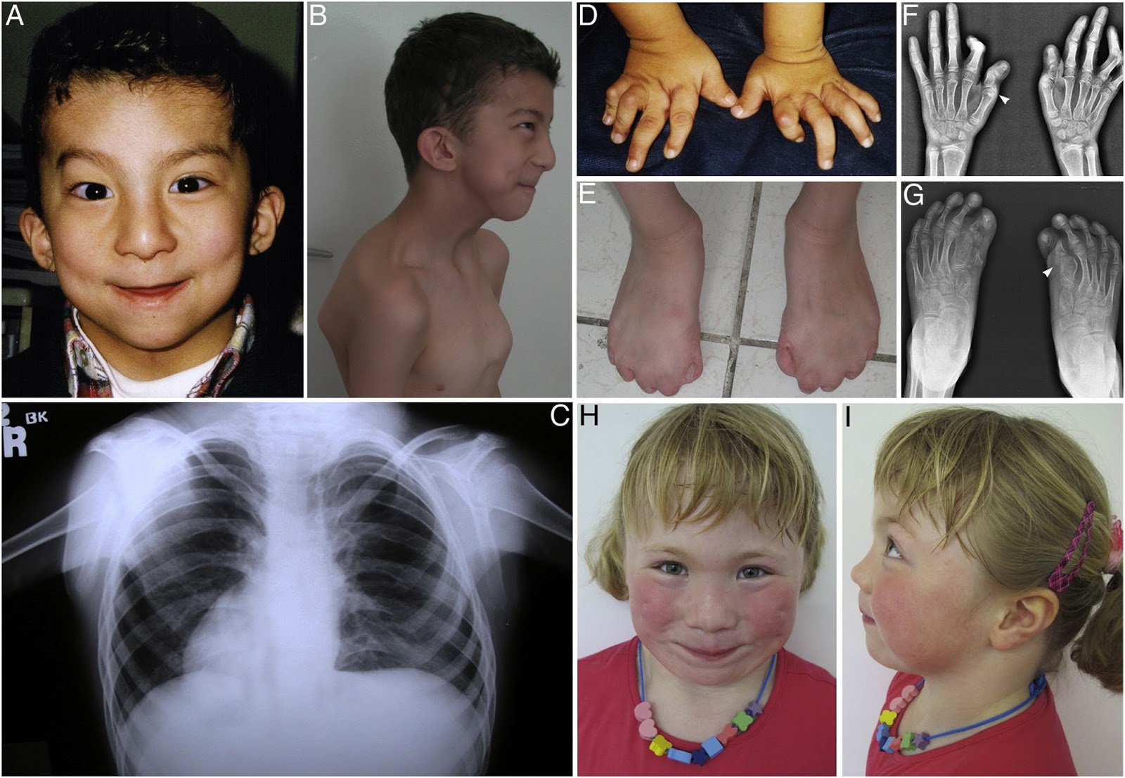 Préserver Ma Santé En Naturel: Le Syndrome de Carpenter