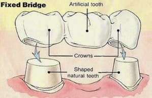 Omni Dental Group: Uprighting Tilted Molars