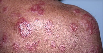 Penularan Penyakit Kusta dan Cara Mengobatinya