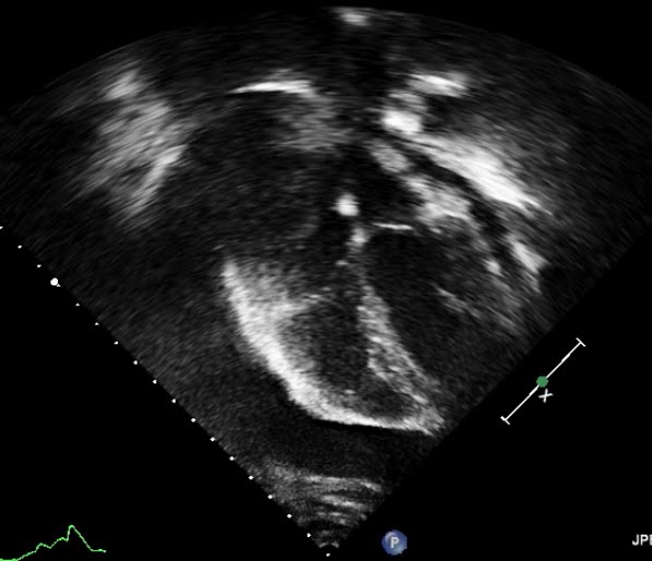 Pedi cardiology: Echo features of tamponade