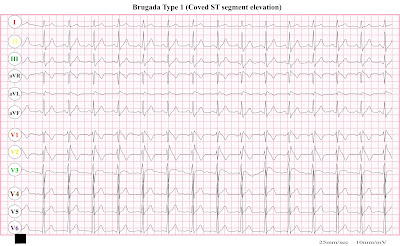 ECG Educator Blog : Brugada Syndrome