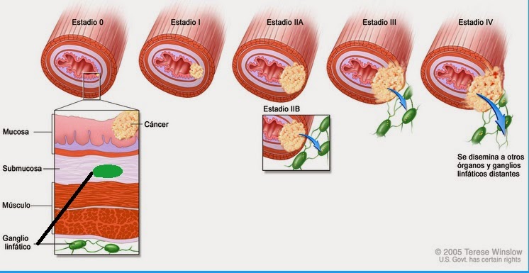 Patología : ESÓFAGO