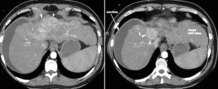 Hepatoma - Sanhi Sintomas Lunas