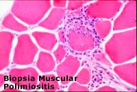 Enfermedades crónicas: Polimiositis y dermatomiositis