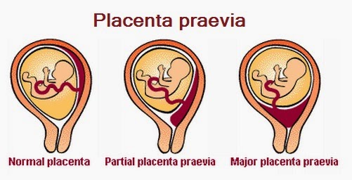 Kenali apa itu plasenta previa dan gejalanya ~ Mamy Syu Malaysia Mommy ...