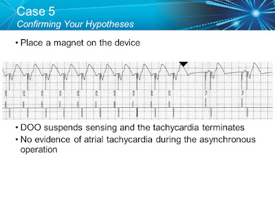 CVT Mohd Farid: Basic Pacemaker Troubleshooting Part II-Medtronic Academy