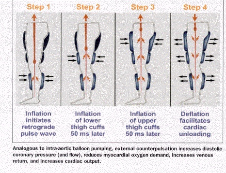 Non Invasive Heart Care: EECP SAVES LIFE
