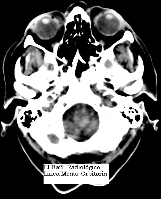 El Baúl Radiológico: LÍNEA MEATO-ORBITARIA (Orbitomeatal Line) by luis ...