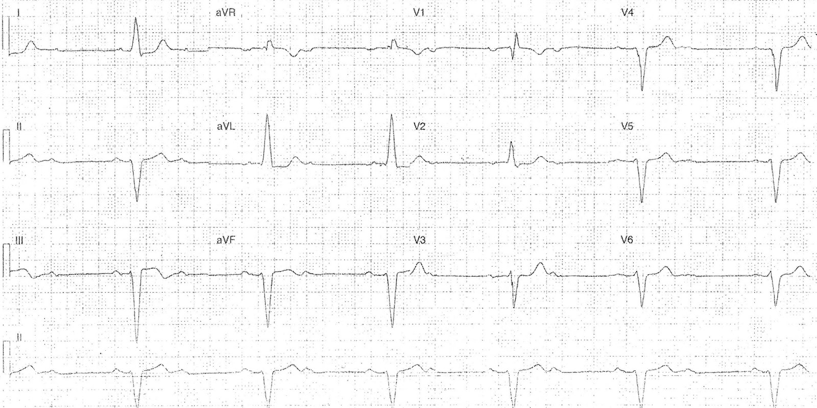 ECG of the Week: ECG of the Week - 12th March 2018 - Interpretation