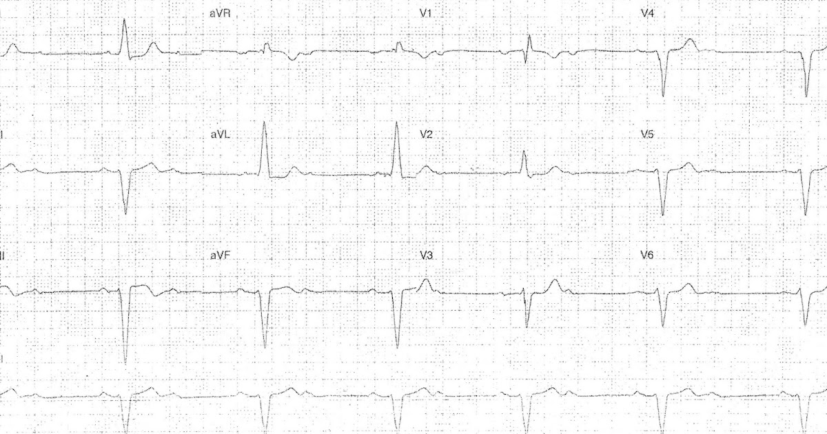 ECG of the Week: ECG of the Week - 12th March 2018 - Interpretation