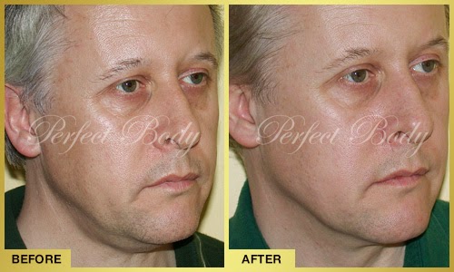 Perfect Body Laser and Aesthetics: Non-Surgical Face/Neck Lift