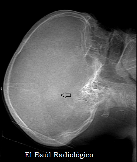 El Baúl Radiológico: OSTEOMAS CRANEALES. (Cranial Osteomas. CT Findings ...