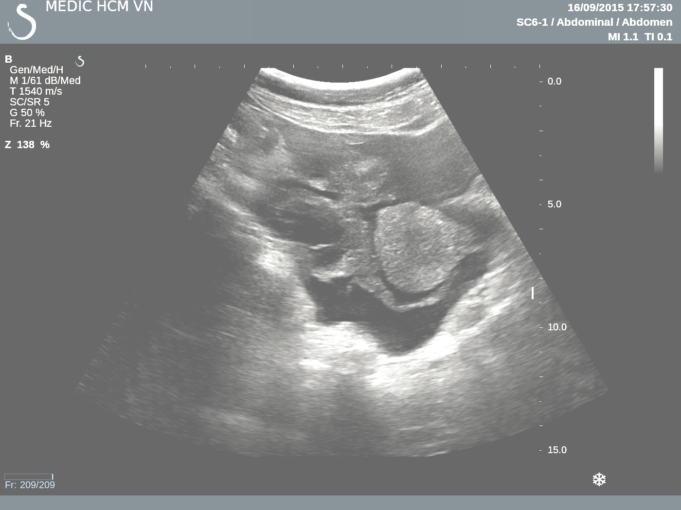 VIETNAMESE MEDIC ULTRASOUND: CASE 335: HEMOPERITONEUM, Dr PHAN THANH ...