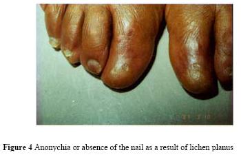 Nail Diseases: Anonychia
