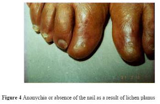 Nail Diseases: Anonychia