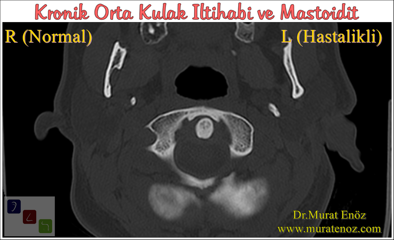 Kronik Orta Kulak İltihabı ve Mastoidit