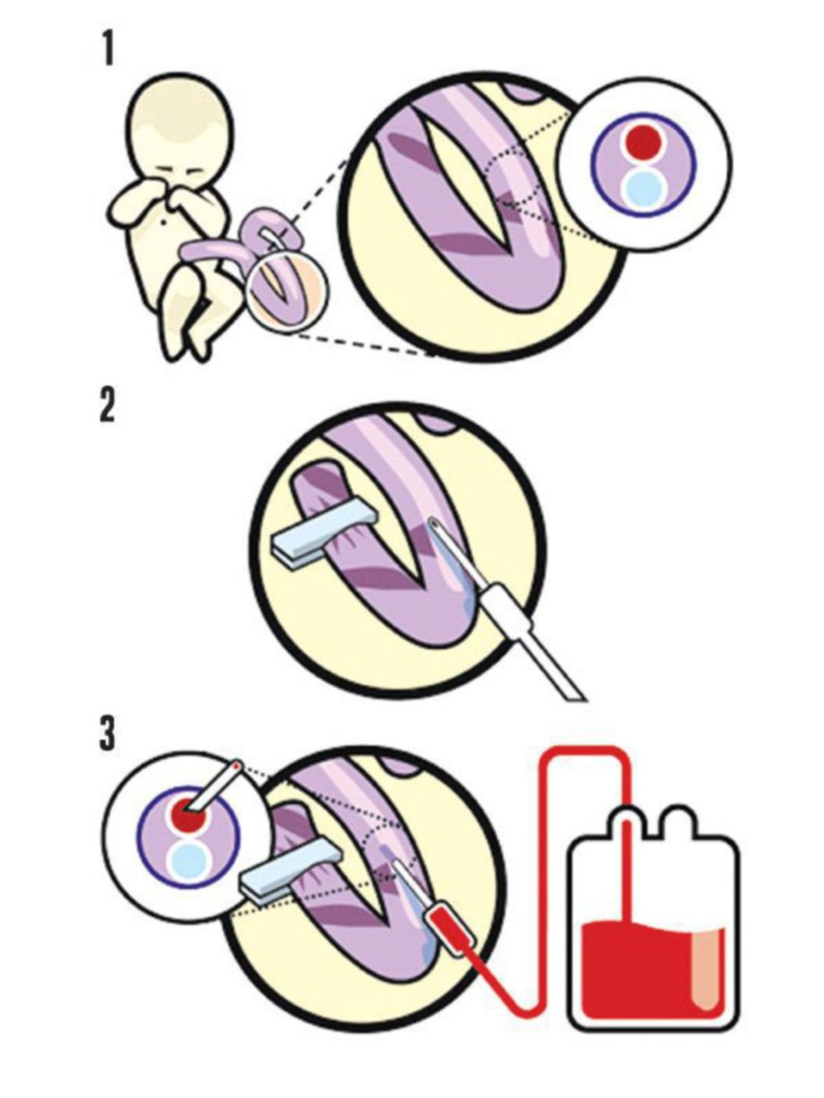TIP-TIP KESIHATAN - BLOG YANG PATUT DIBACA: MANFAAT DARAH TALI PUSAT