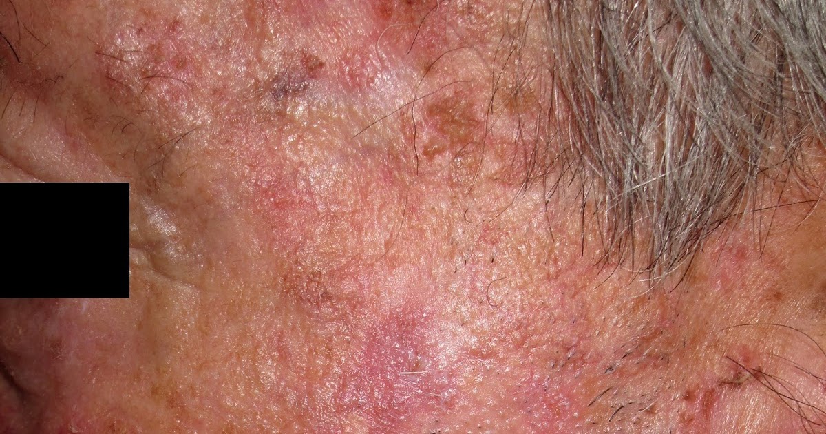 Dermapixel: Demasiadas queratosis actínicas