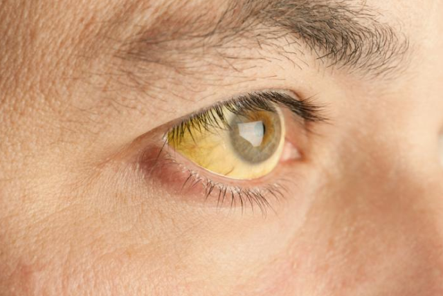 Causes Symptoms and Treatment of Jaundice Yellow Skin | Education and ...