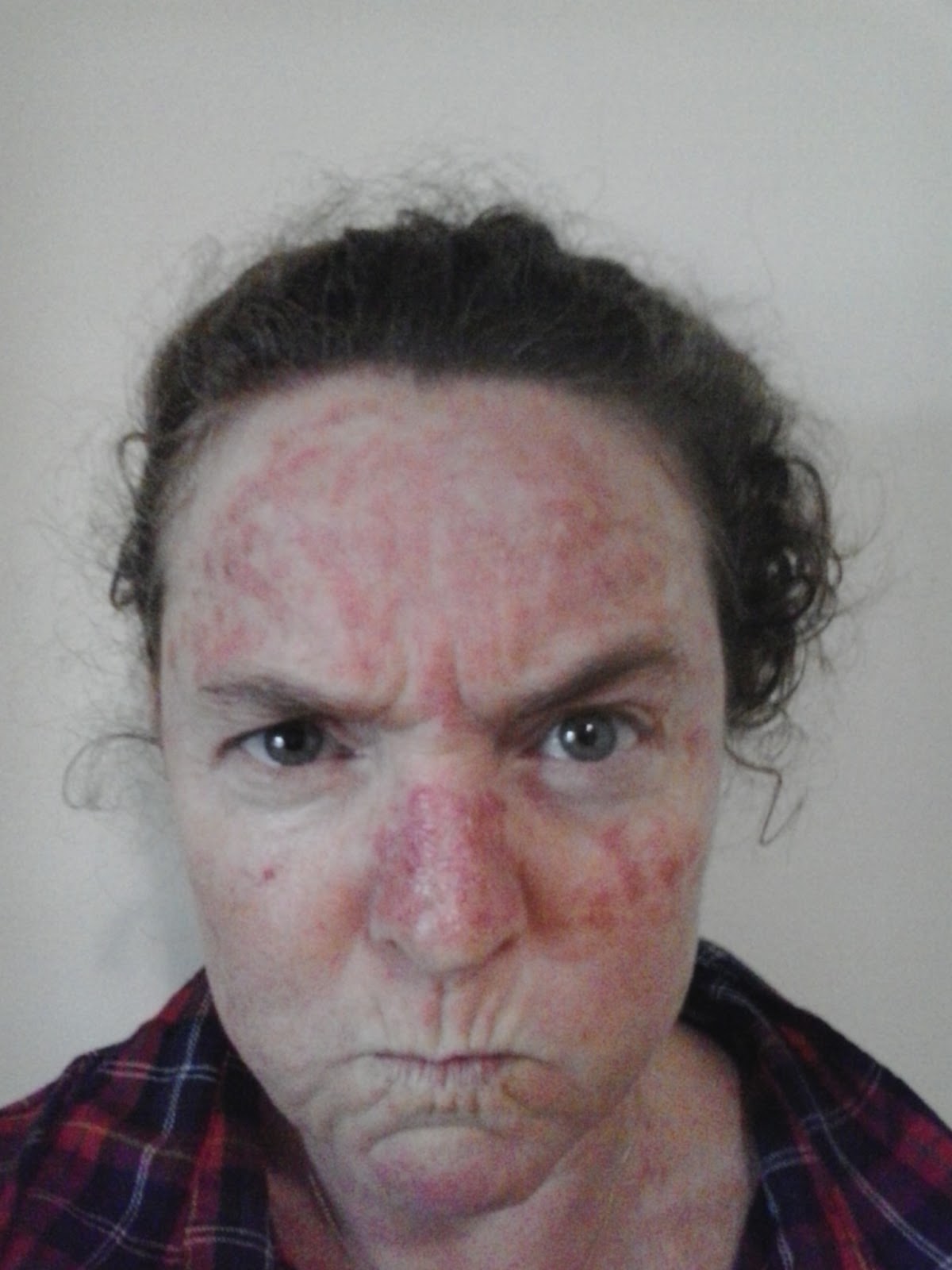Portrait of a (Sun) Damaged Lady, or Get Thee to a Dermatologist