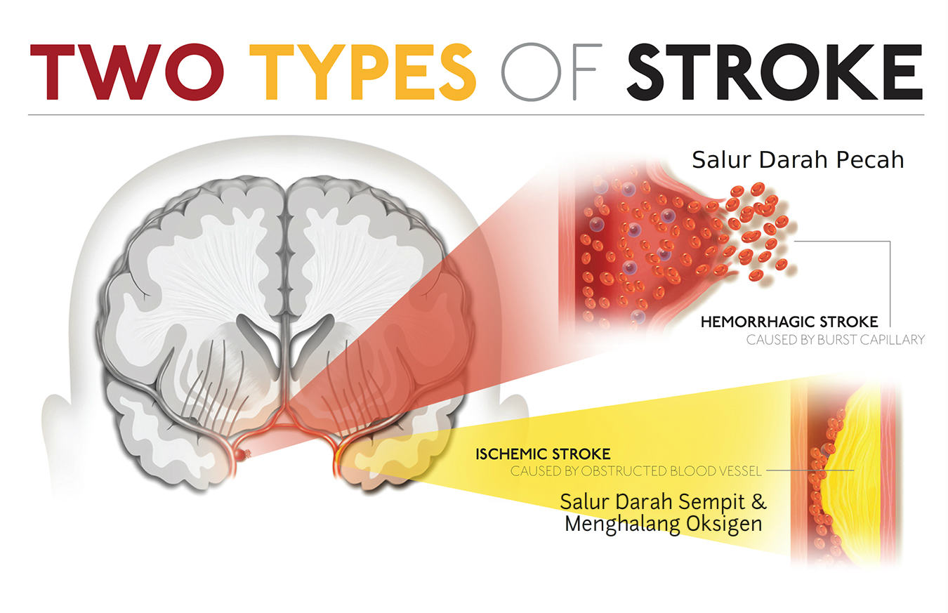 Siapa Bilang Strok Itu Mendadak?....Kenali Isyaratnya!!! | Tasly ...