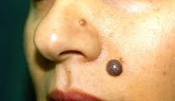Photos of Moles on Face and Neck ~ How To Remove Moles, Warts, Skin ...
