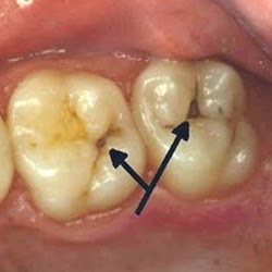 Caries en los dientes
