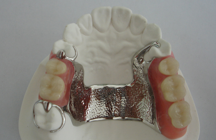 Metal Partial Dentures Pictures : Vestakeep Peek For Dental ...