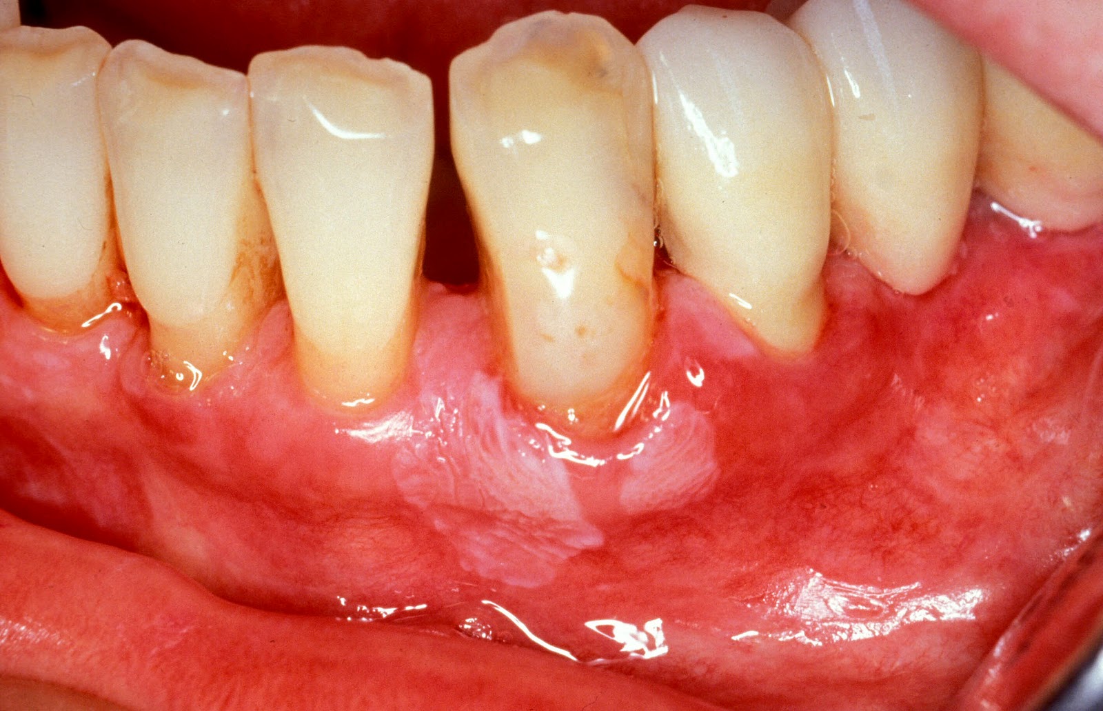 FRENKENKLINIK: Parodontitis (Parodontose)