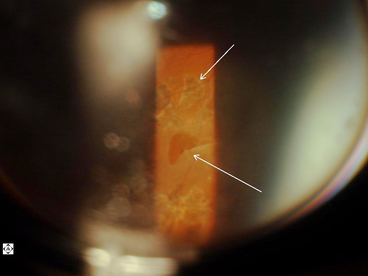 Sonoran Desert Eye Center: TREATED RETINAL HORSESHOE TEAR