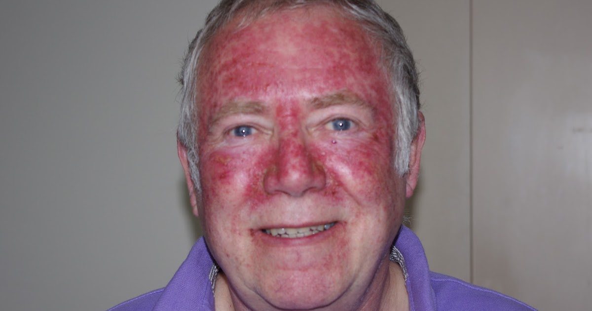 Alan's Efudix/Efudex Experience