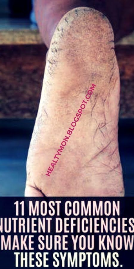 OKHOMOL: 11 Most Common Nutrient Deficiencies. Make Sure You Know These ...