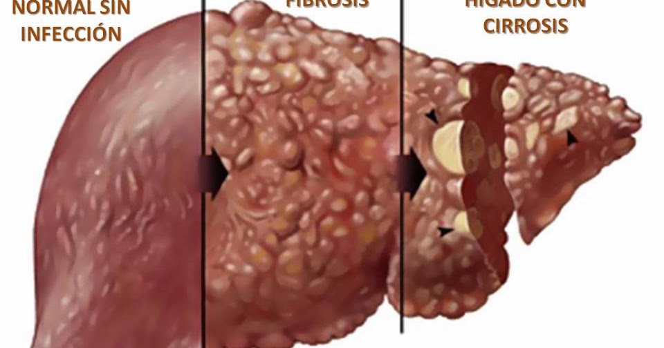 CIRROSIS HEPÁTICA: Definición de Cirrosis hepática