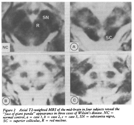 Ultimate Radiology : Abstract from Original Article on WIlson's Disease ...
