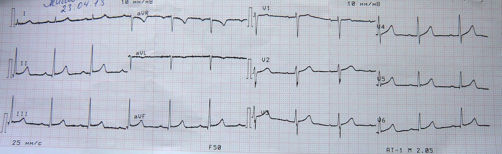 Скорая медицинская помощь: ИБС: Стенокардия - MCC (Morbus cordis ...